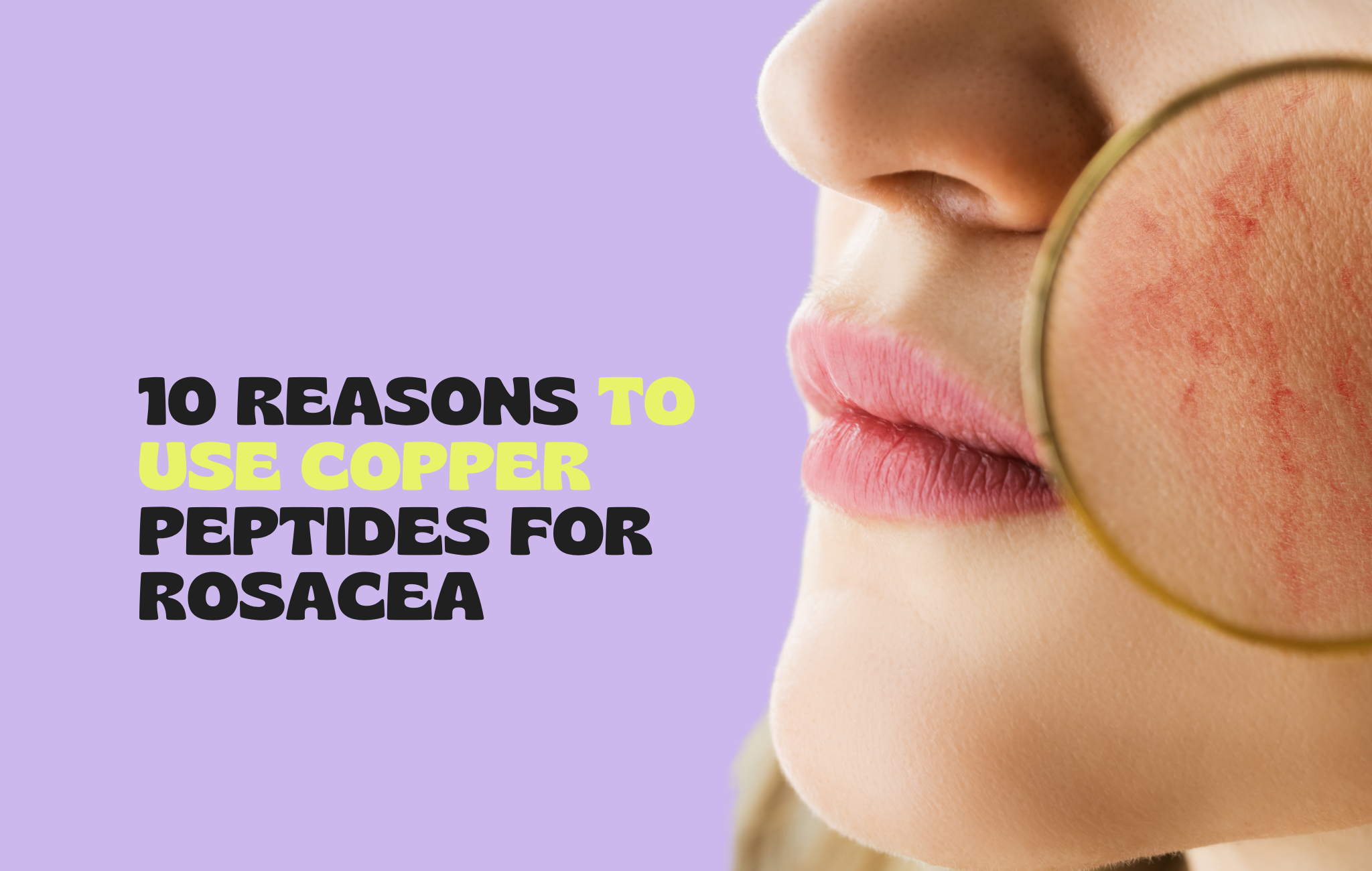 Reasons to Use Copper Peptide Patches to Treat Rosacea | HapiPatch.com